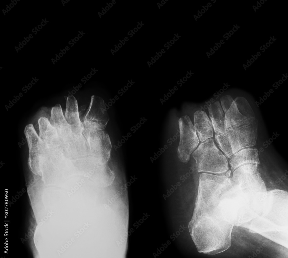 X-ray image of diabetic foot amputation, oblique view Stock Photo ...