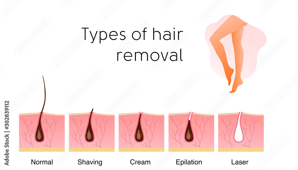 Comparison of the popular methods of hair removal: shaving, cream ...