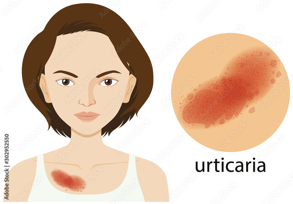 Diagram showing urticaria on human female Stock Vector | Adobe Stock