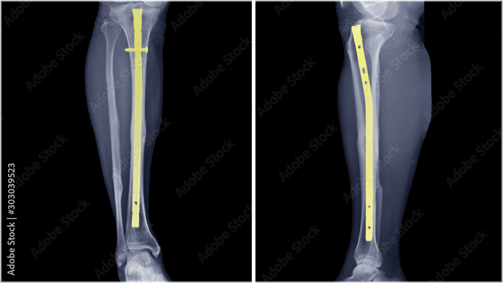 Photo & Art Print Film leg X ray radiograph show leg bone broken (tibia ...