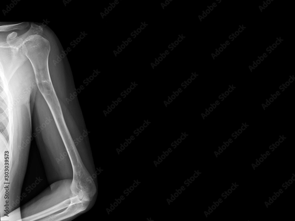 Film X-ray shoulder radiograph show Aneurysmal bone cyst disease (ABC ...