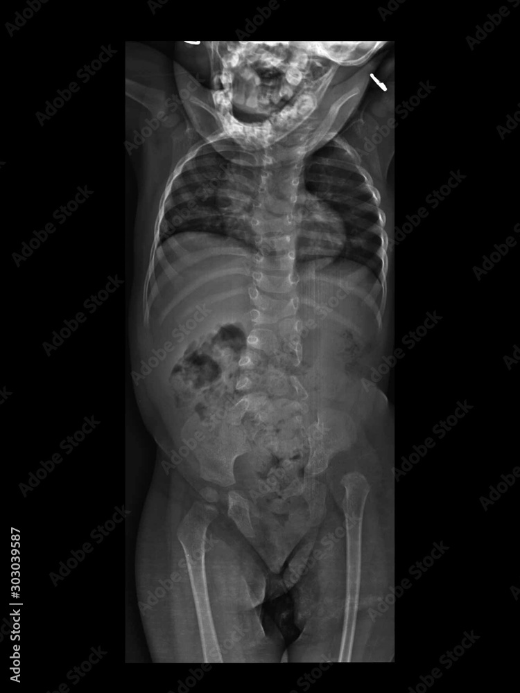 Film X-ray radiograph show congenital spine and hip abnormalities. The ...
