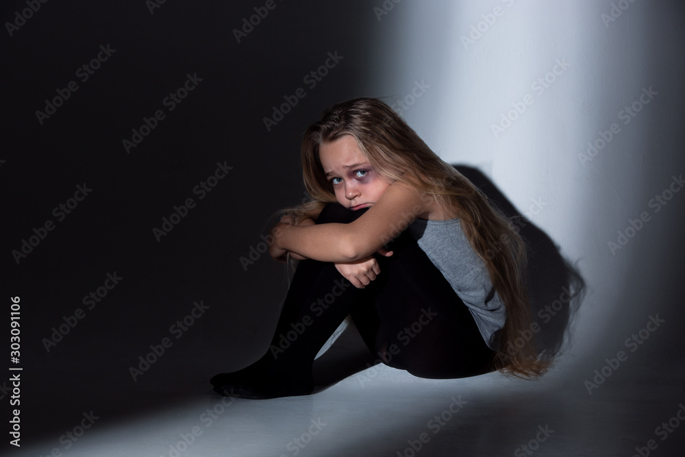 Sad and frightened little girl with bloodshot, bruised eyes sitting ...