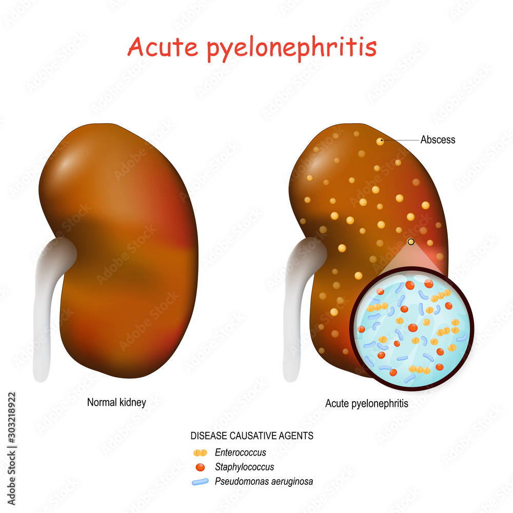 Pyelonephritis