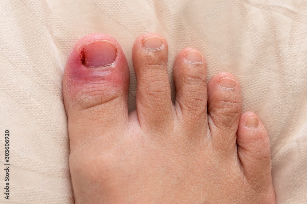 Rotten nails, Close up of rotten toenails. Stock Photo | Adobe Stock