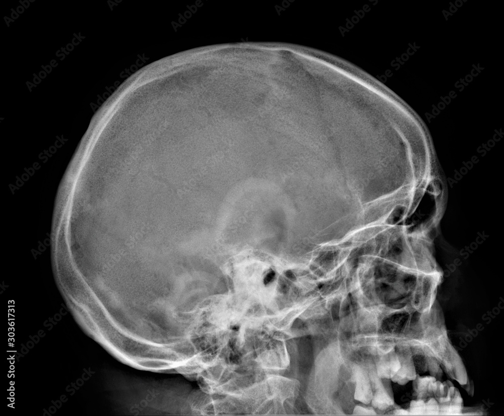 normal radiography of the skull in lateral projection, medical ...