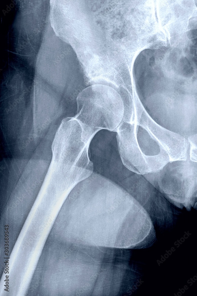 radiografia de la articulacion de la cadera Stock Photo | Adobe Stock