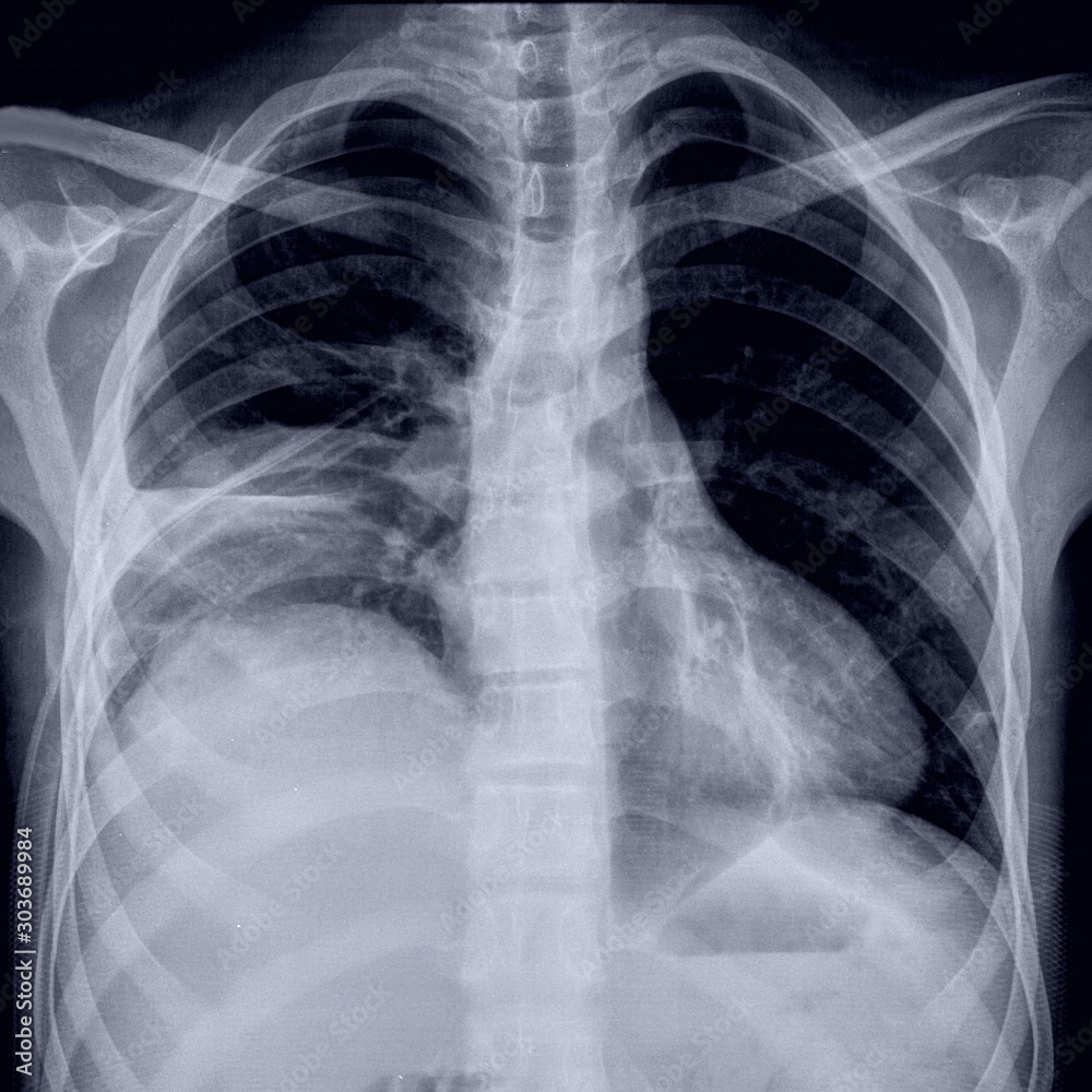 radiografia con neumotorax y atelectasia Stock Photo | Adobe Stock