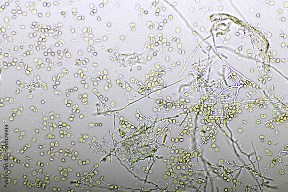 Picture of fungus and red blood cells in hemoculture tube, analyze by ...