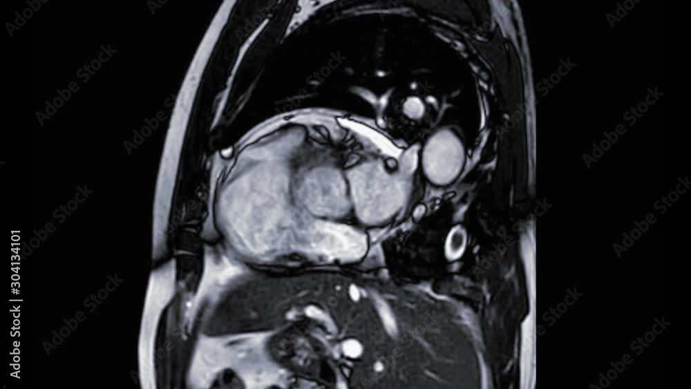 MRI heart or Cardiac MRI or magnetic resonance imaging of heart showing ...