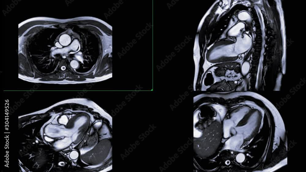 MRI heart or Cardiac MRI or magnetic resonance imaging of heart compare ...
