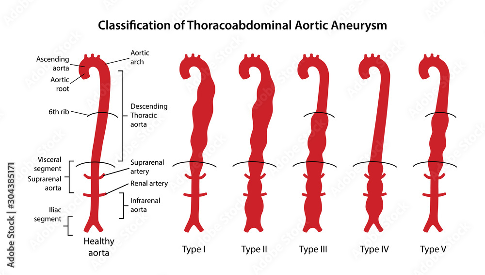 Classification of Thoracoabdominal Aortic Aneurysms. Healthy aorta with ...