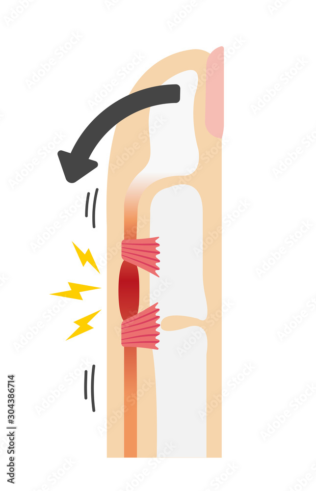 Trigger finger causes and symptoms illustration / when bending Stock ...