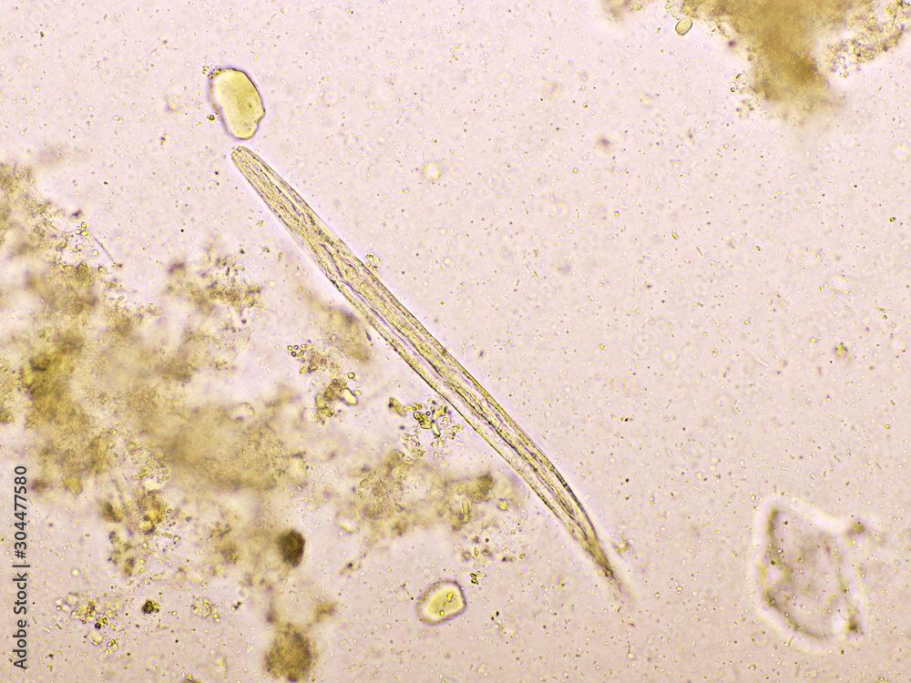 Strongyloides stercoralis or threadworm in human stool, analyze by ...