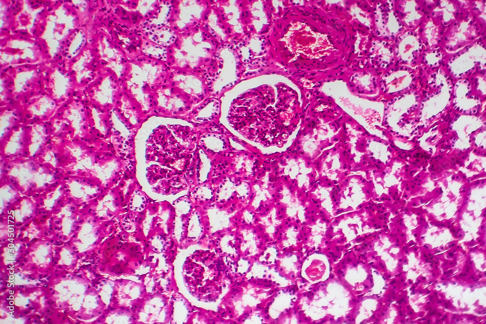 Tubular atrophy, light micrograph, photo under microscope Stock Photo ...