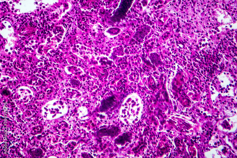 Histopathology of acute nephritis, light micrograph, photo under ...