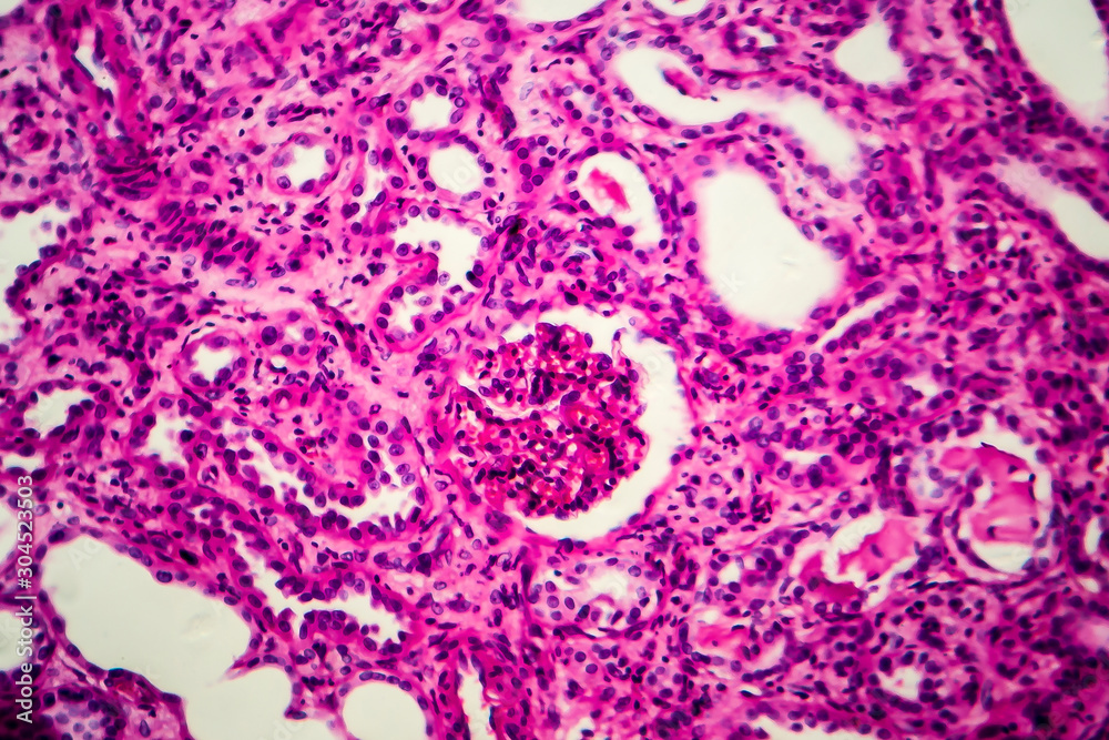 Chronic pyelonephritis, light micrograph, photo under microscope Stock ...