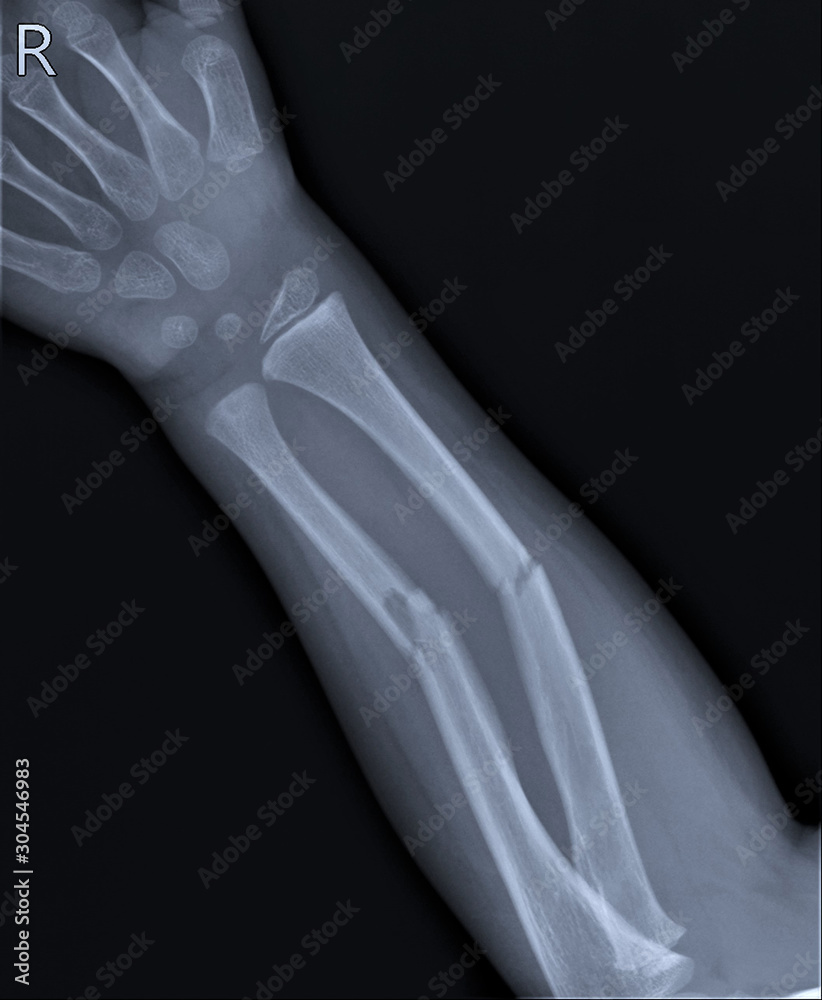 radiography of the forearm with a fracture of the radius and ulna ...