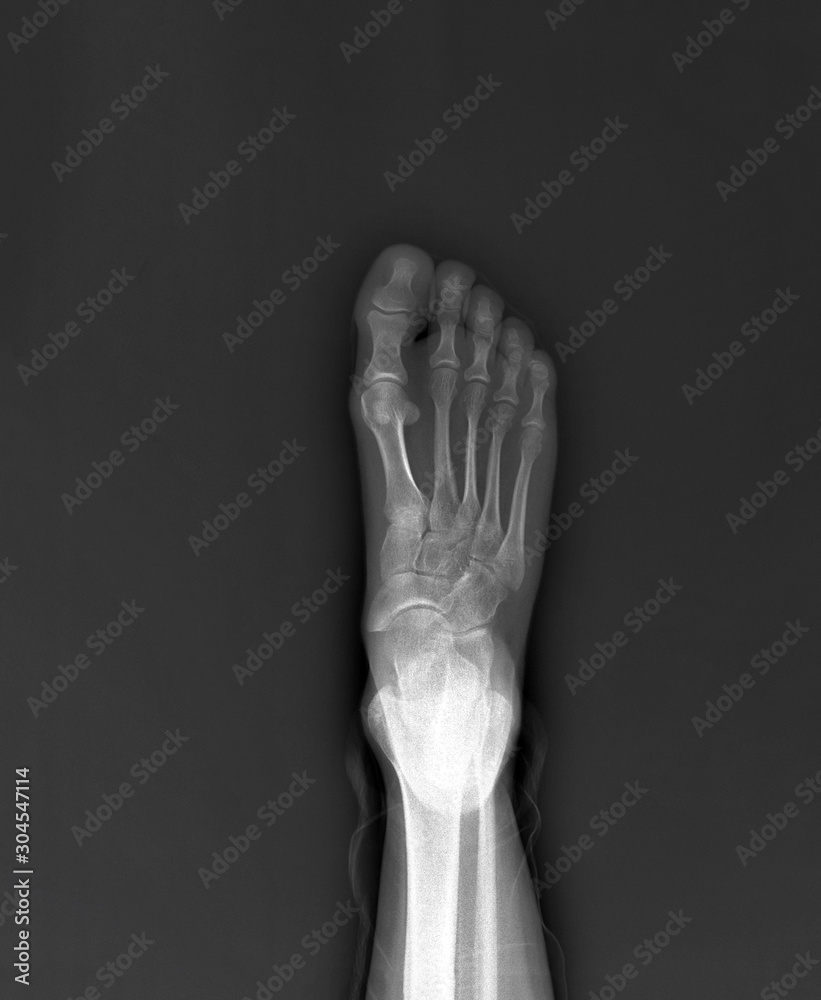 normal radiography of the foot, medical diagnostics, traumatology and ...