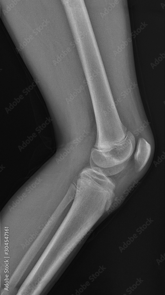 normal radiography of the knee joint in lateral projection, medical ...
