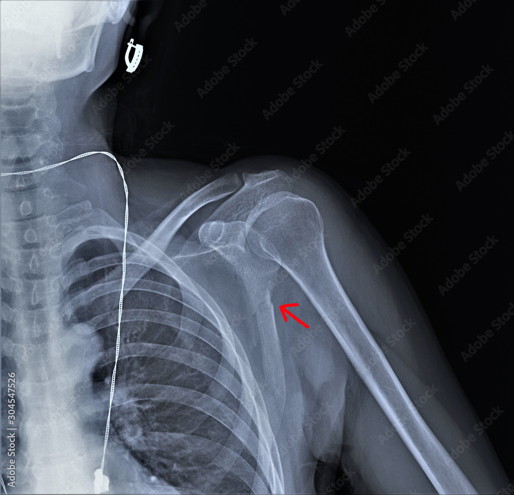 radiography of the shoulder joint in direct projection with a fracture ...