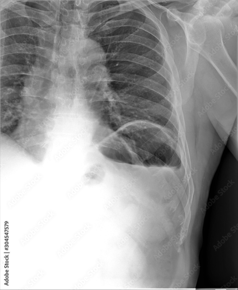 normal radiography of the shoulder joint in direct projection ...