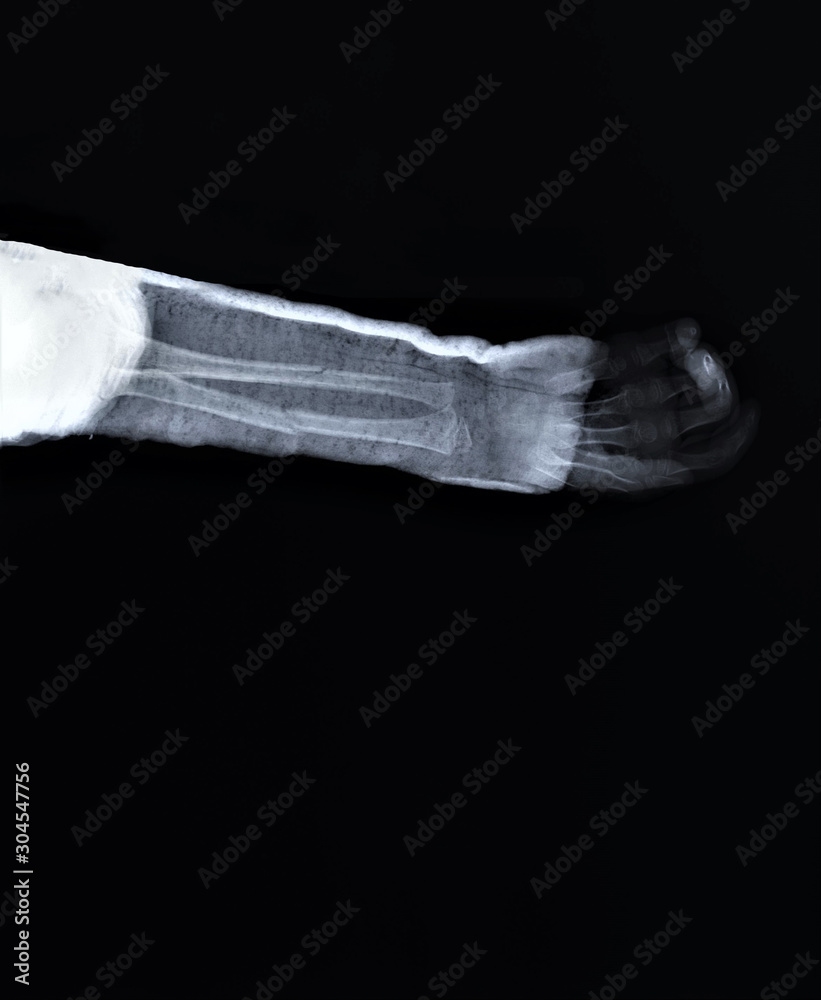 radiography of the forearm with a fracture of the radius and ulna with ...