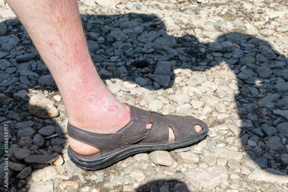 Sunburnt on man left leg. Tan on leg of man skin, red skin, blisters ...
