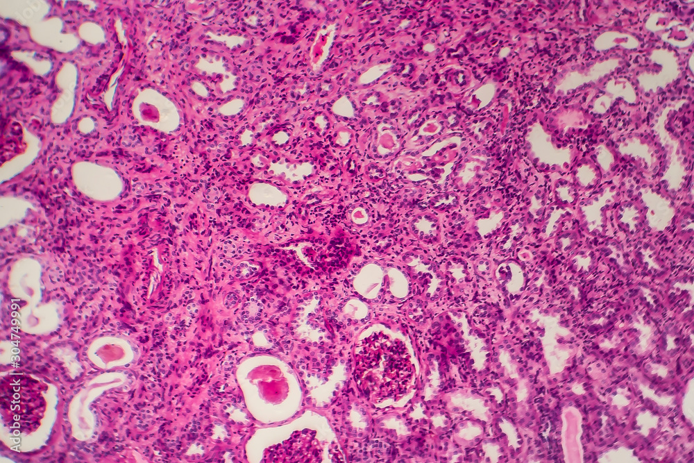 Chronic pyelonephritis, light micrograph, photo under microscope Stock ...