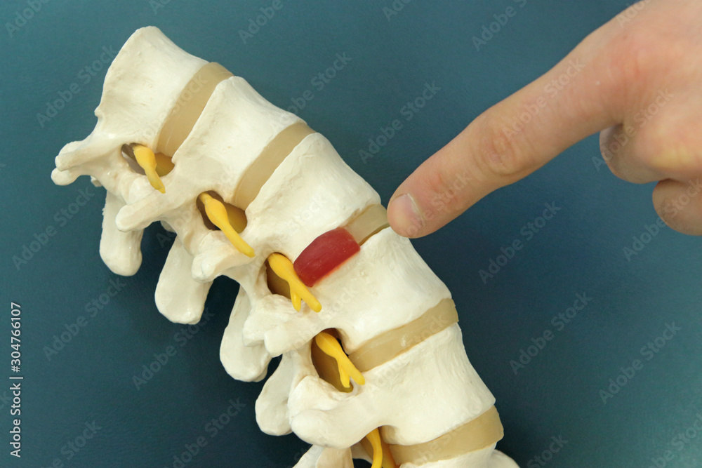 Finger pointing at spinal hernia - model Stock Photo | Adobe Stock