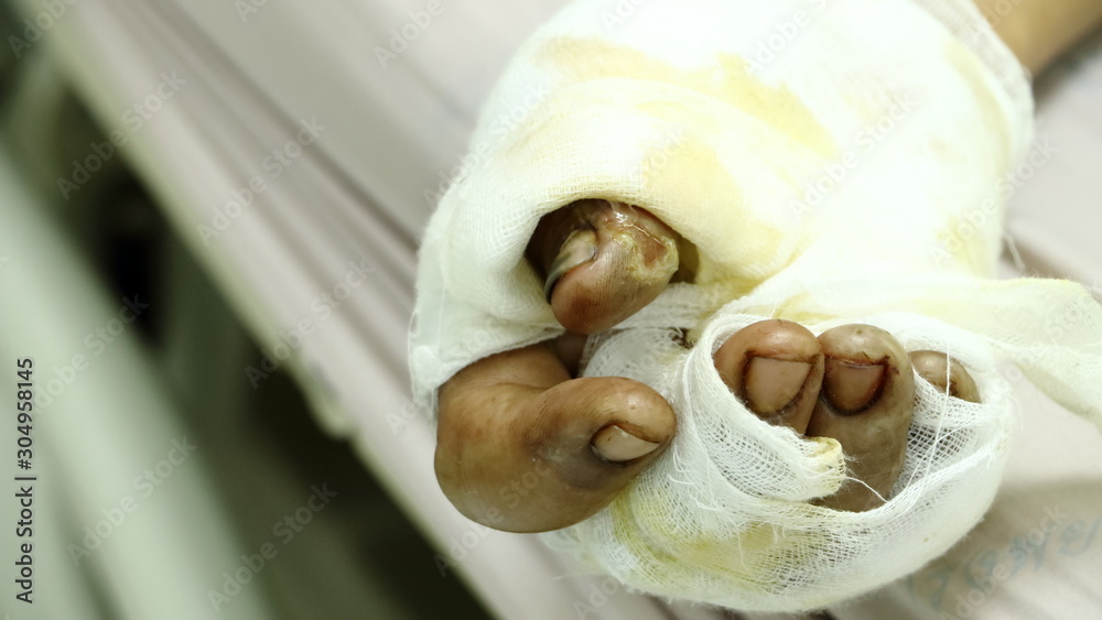 Burn from hot oil splashed on the hand And wound by sterilizing and ...