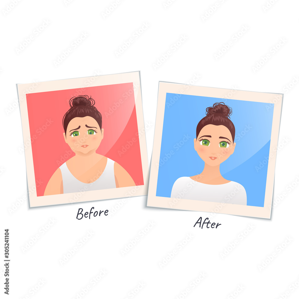 Cartoon illustration of two photographs of a woman before and after ...