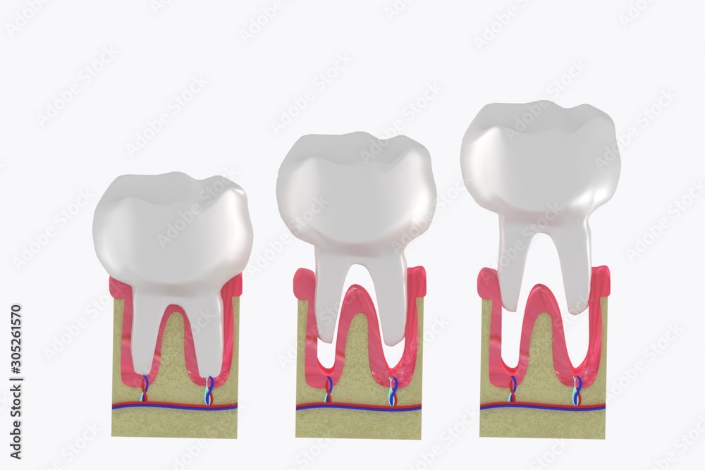 Molar extraction. Tooth loss Anatomical structure. 3d medical ...