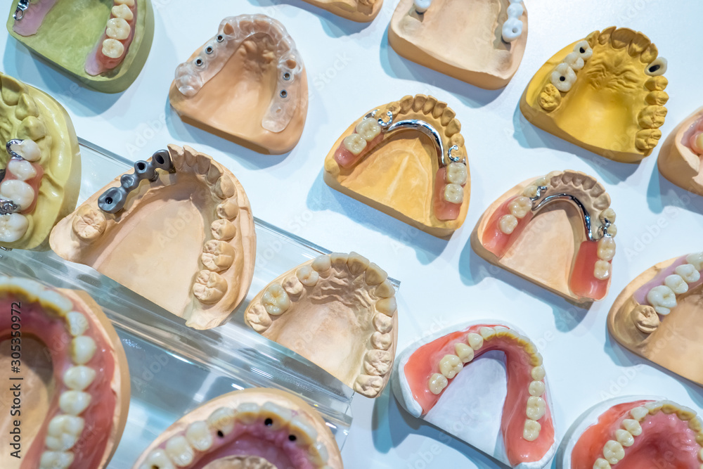 Dental models. Jaw models with different problems. Treatment of dental ...