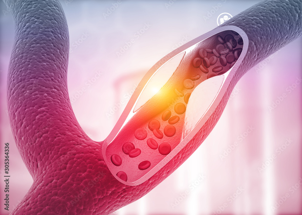 Atherosclerosis, Cholesterol plaque in artery. 3d illustration Stock ...