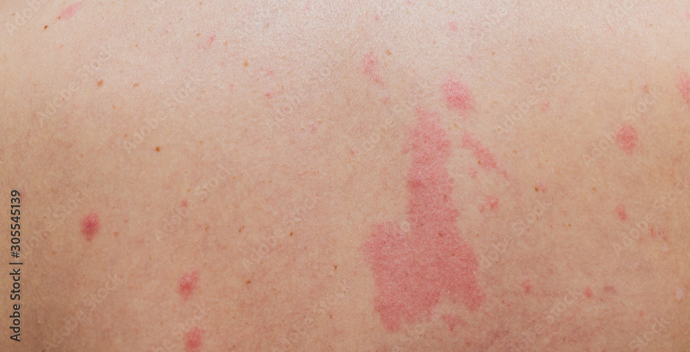 Close up Allergy rash, Around Back view of human with dermatitis ...