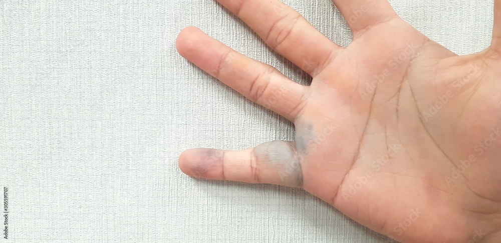 Man's hand has varicose veins in his right finger and swollen or ...