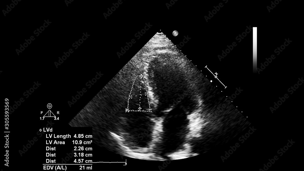 Screen of an ultrasound machine with a heart image. Stock Photo | Adobe ...