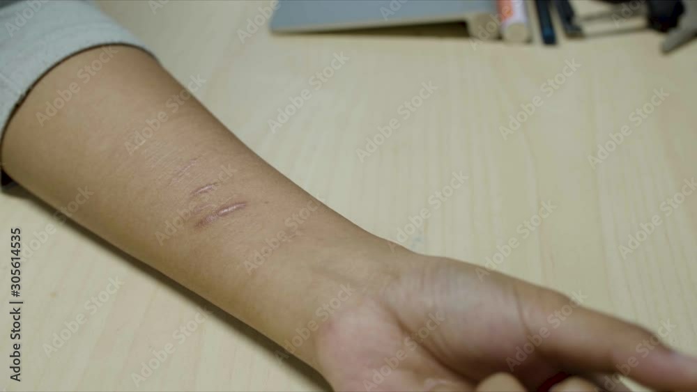 Person who tried to commit suicide by cuting her wrist seeks medical help from a doctor or ...