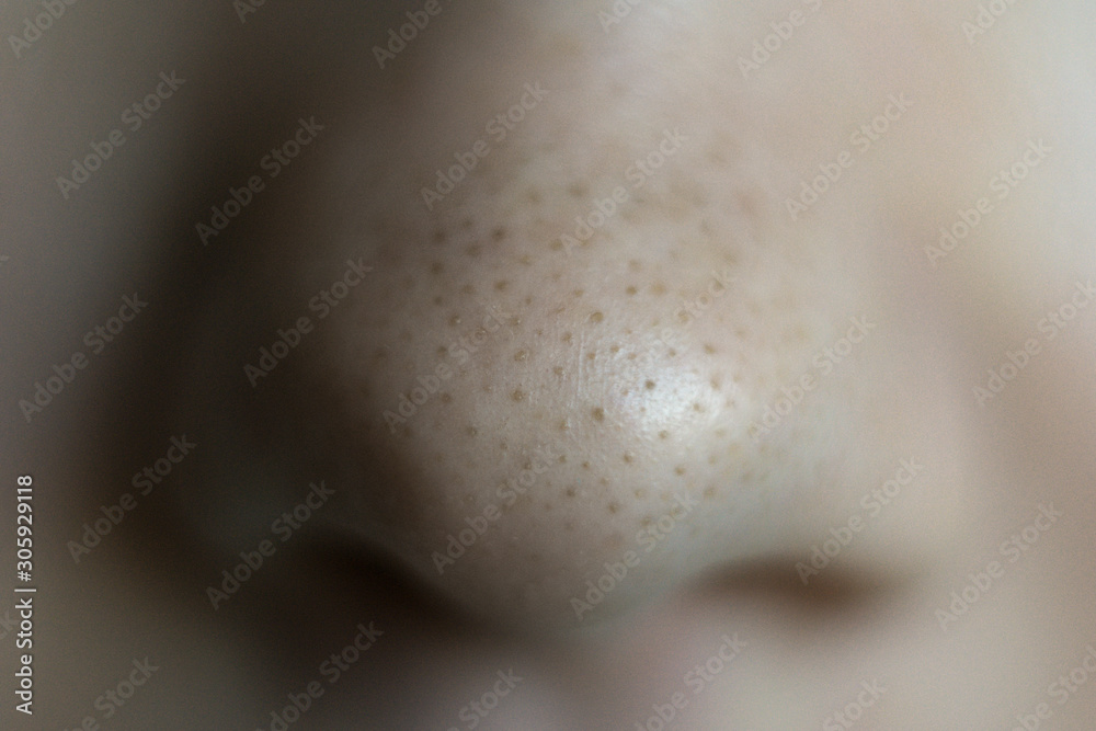 Black dots on the nose. Close up. Stock Photo | Adobe Stock
