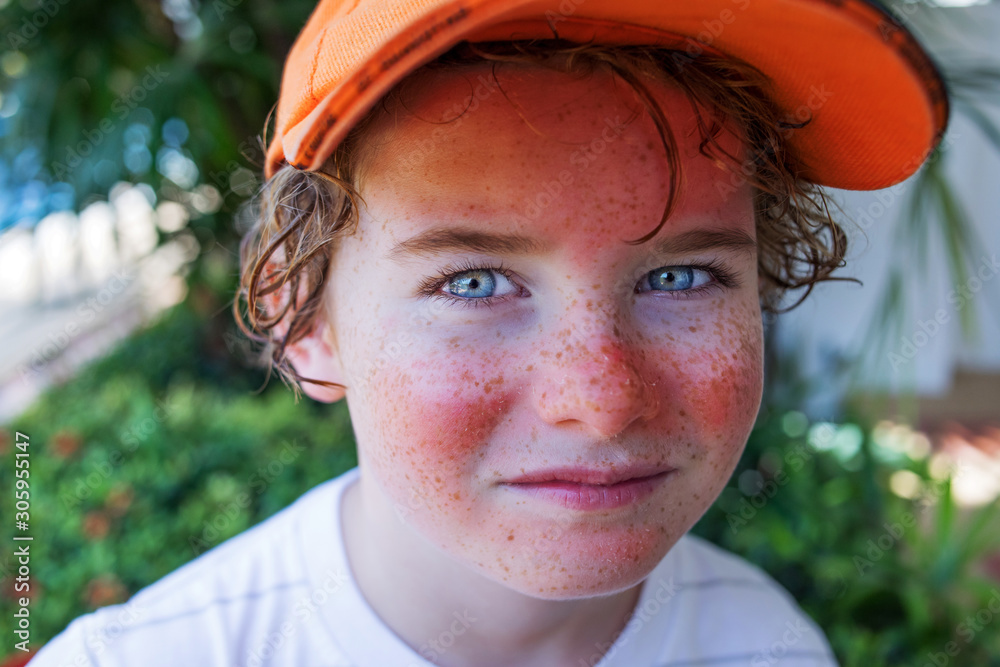 red painful skin, sunburn on the boy's face, sunburn protection need ...