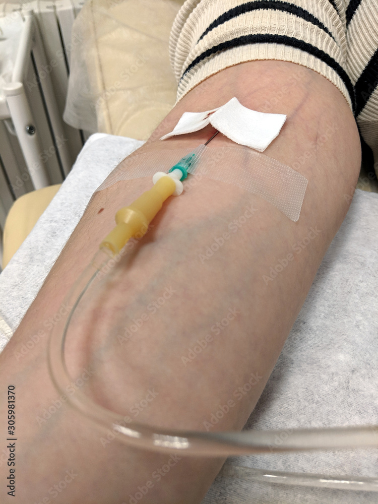 IV drip (phleboclysis) needle in arm of a patient Stock Photo | Adobe Stock