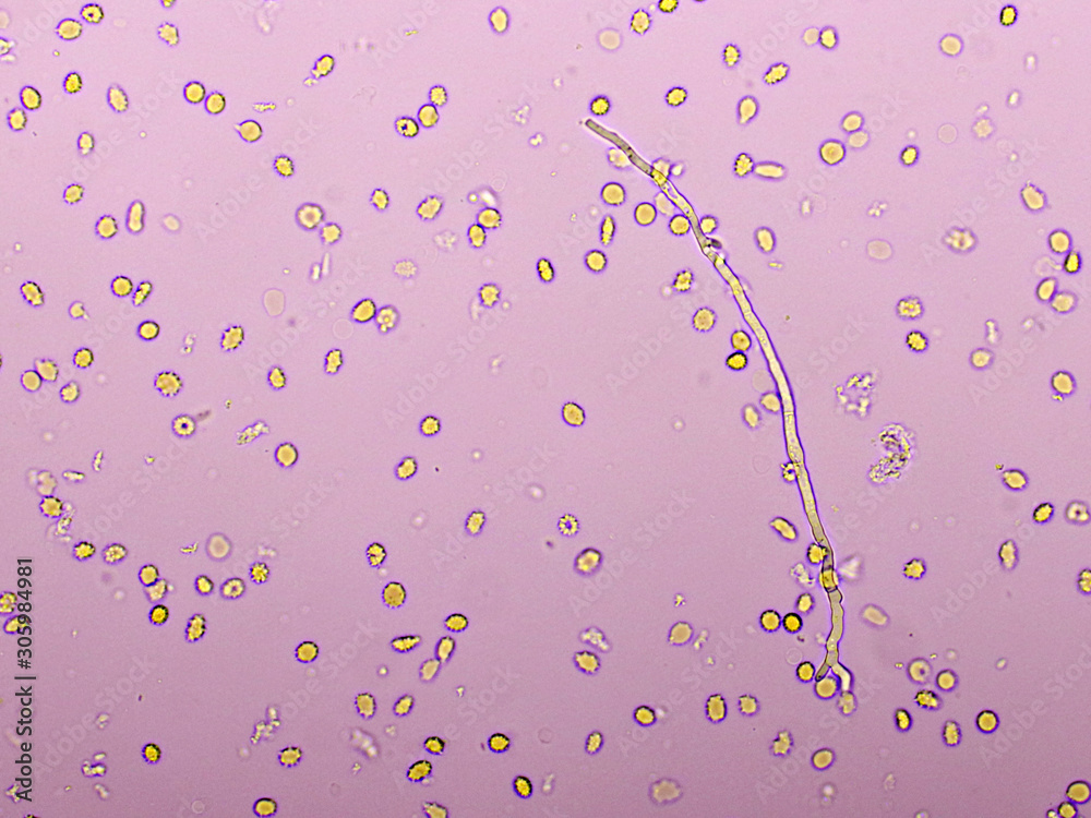 Foto de Picture of fungus and red blood cells in hemoculture tube ...