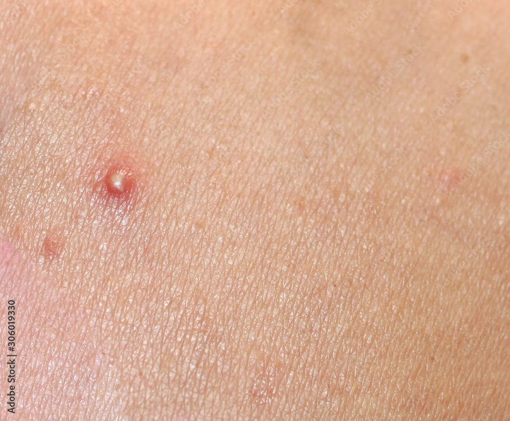 Inflamed skin on the face. Acne. Pimples on the skin. Scars and peeling ...