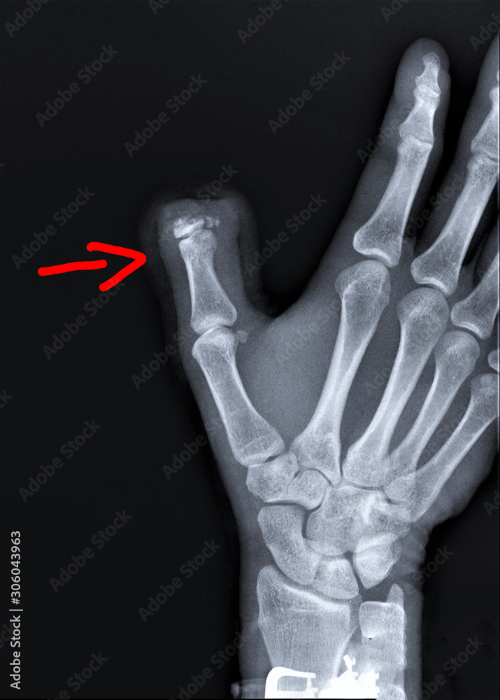 radiography of hand and wrist bones with amputation of the nail phalanx ...