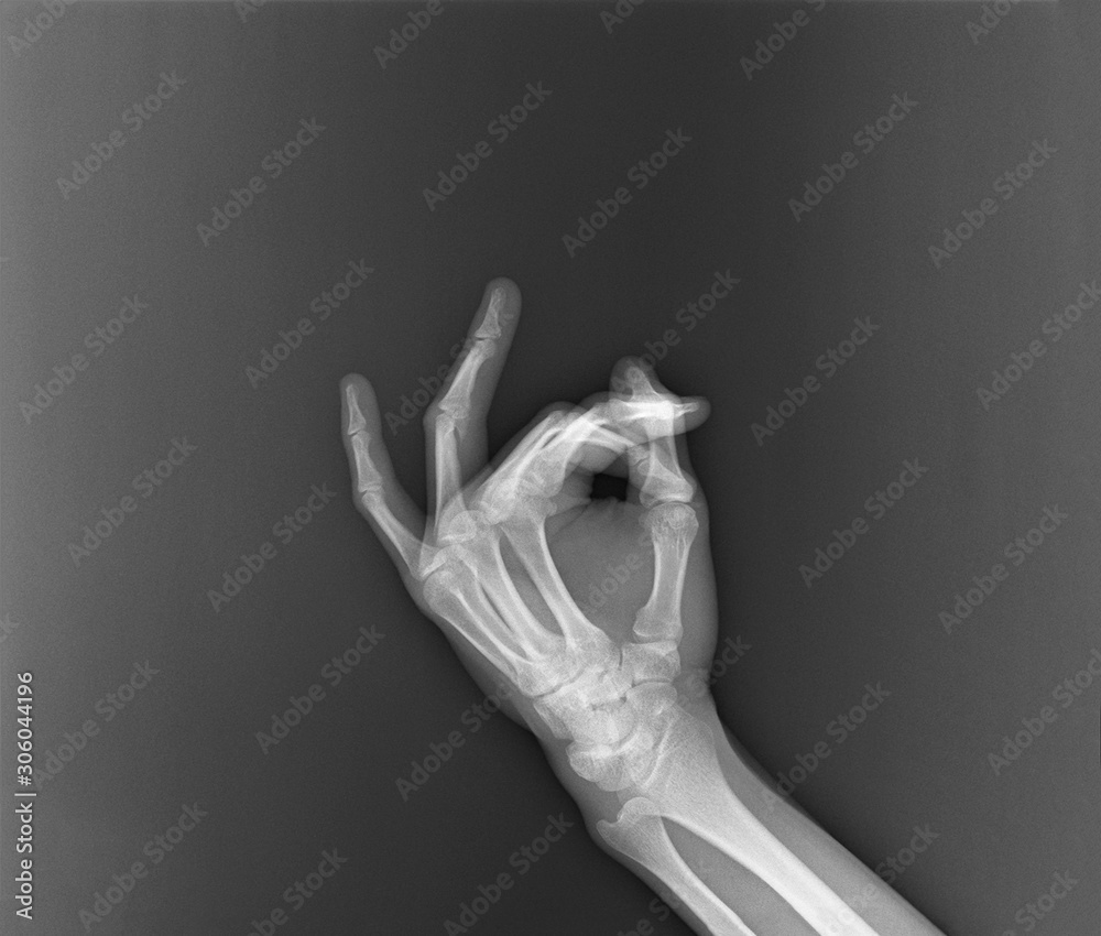 normal x-ray of the hand bones and fingers,orthopedics, medical ...