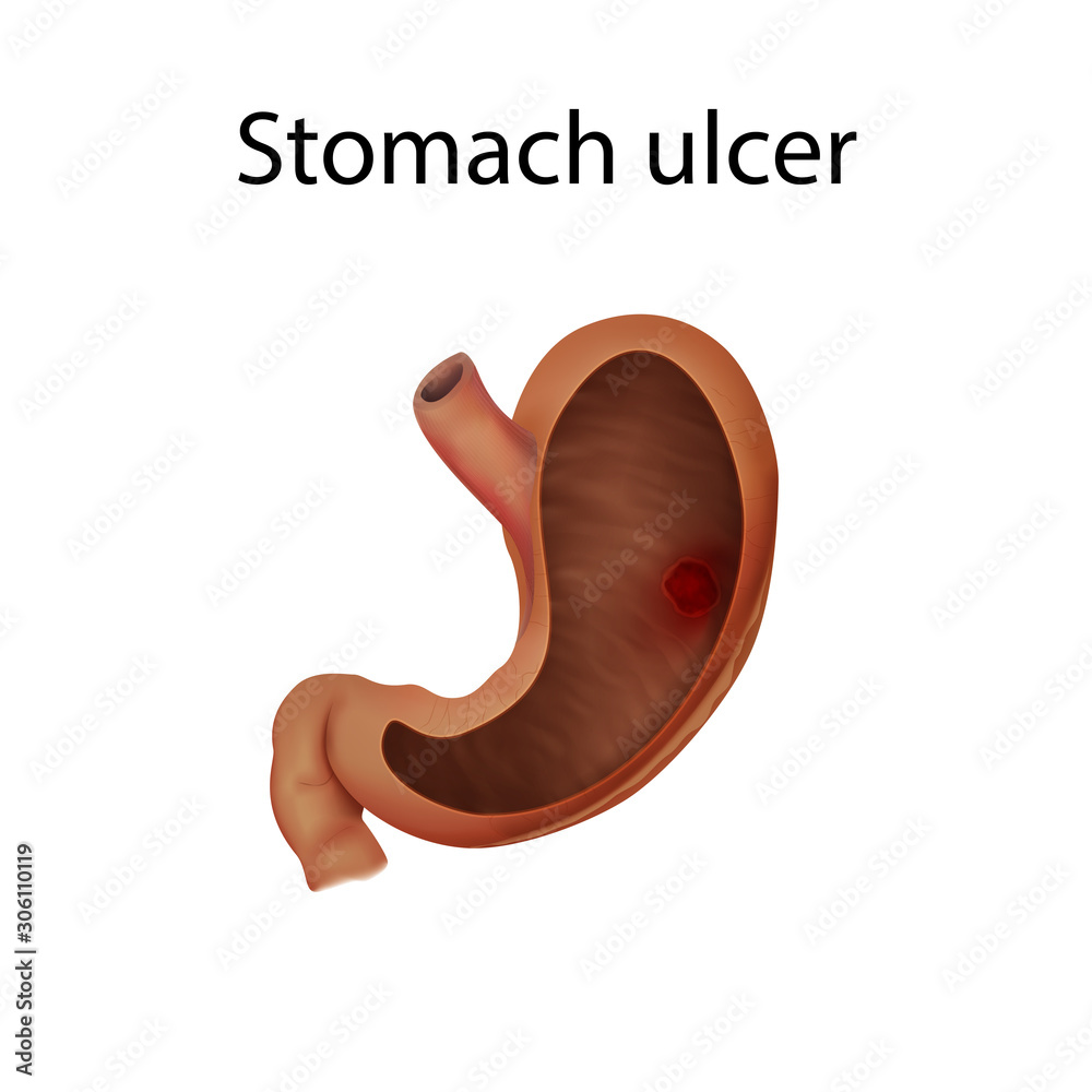 Stomach ulcer. Perforation, hole. Medical anatomy illustration. Stock ...
