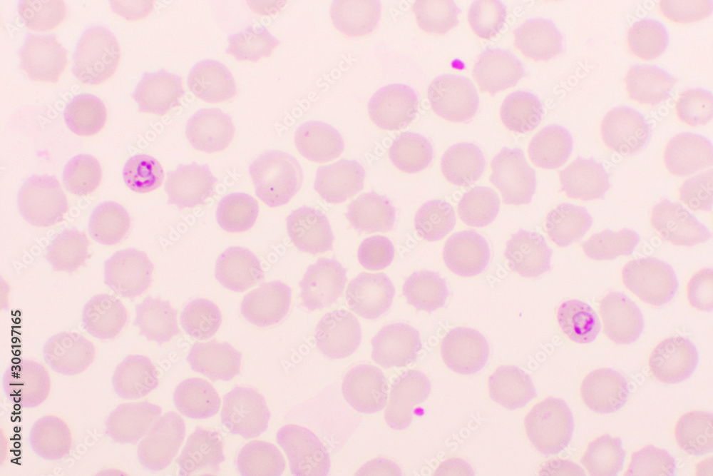 Malaria parasite in red blood cells, ring form stage of Plasmodium ...