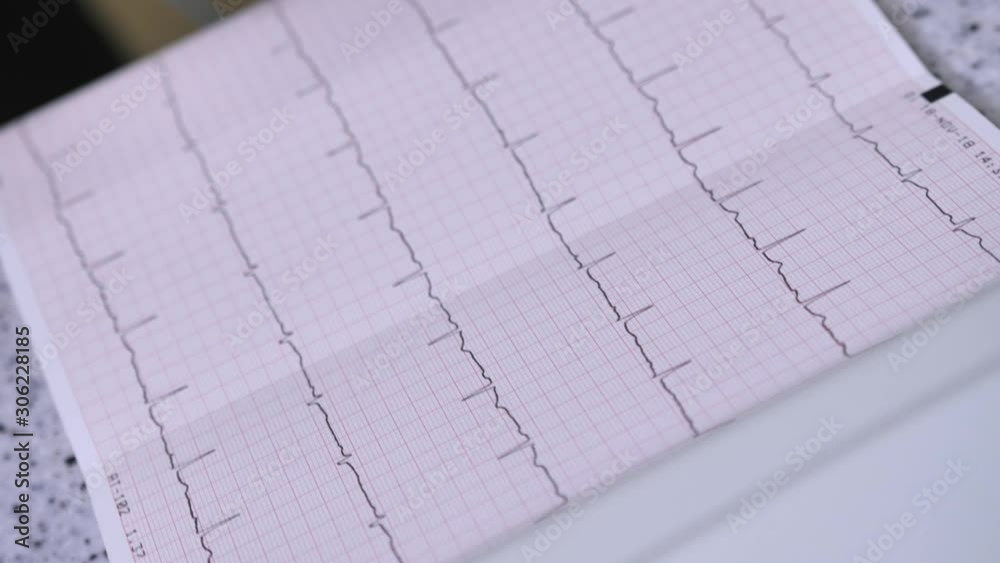 Medical heart monitor strip. Heart monitor printing electrocardiogram ...
