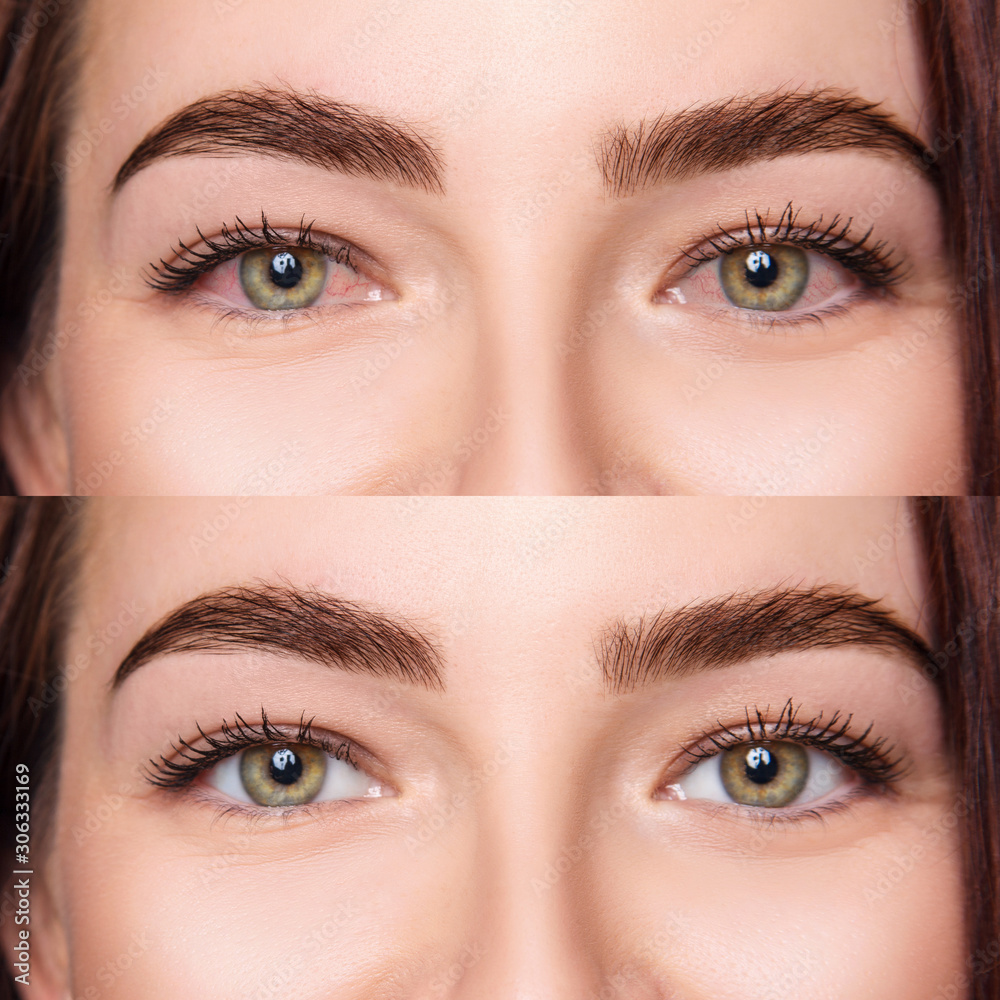 Irritated female eyes with redness before and after treatment. Stock ...